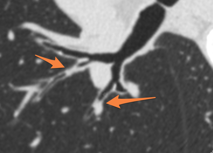 VIDA - Quantitative Assessment of Mucus Plug Burden